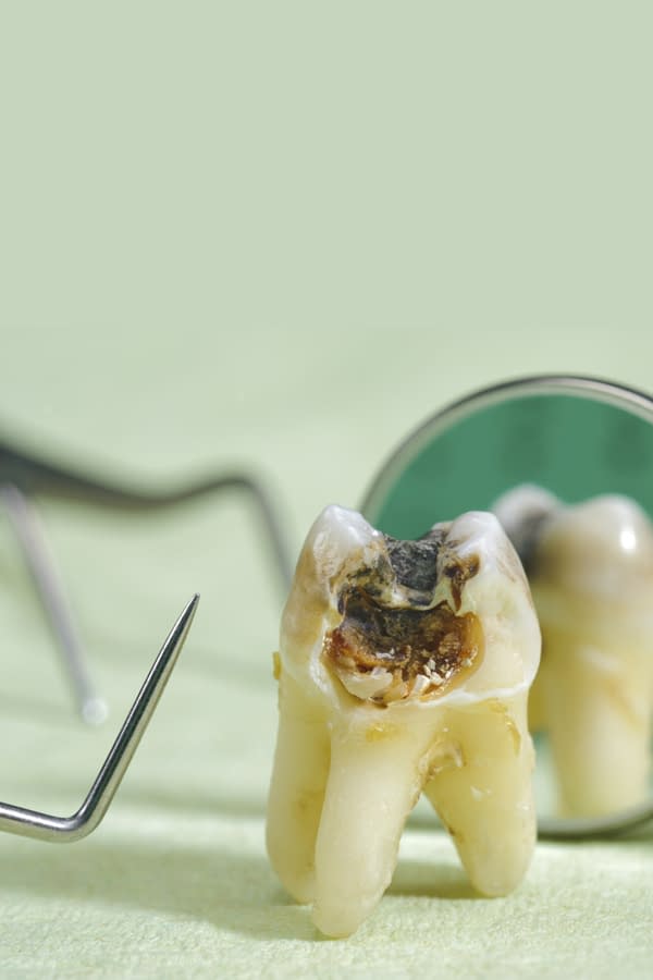 Traitement des caries - Cabinets d'orthodontie à Neuchâtel & Lausanne